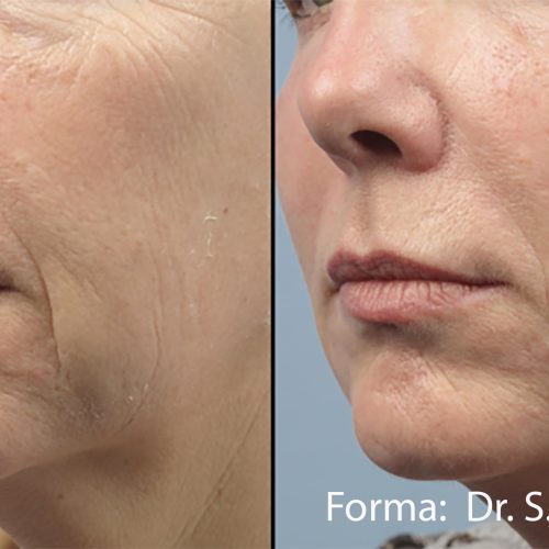Forma Skin Tightening - Mirror Mirror Med Spa